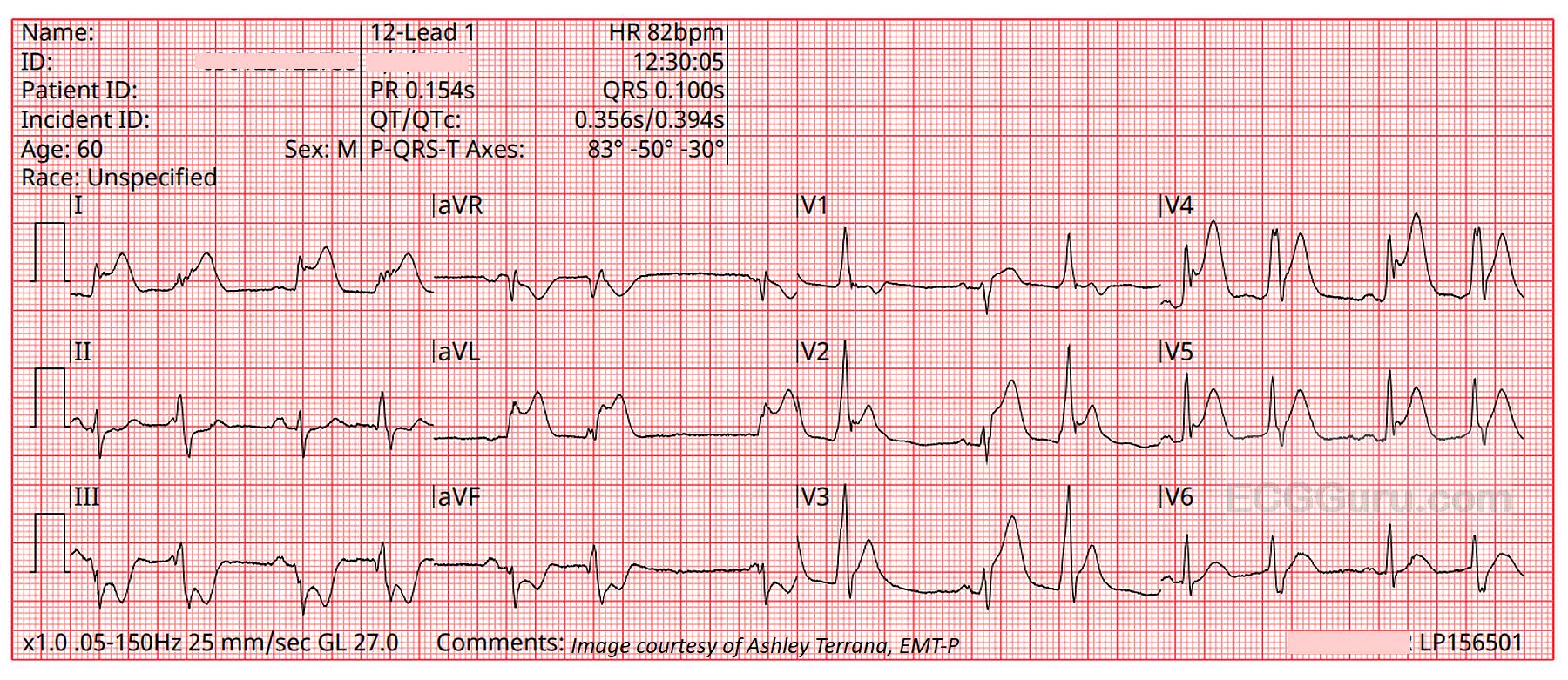 Acute Anterior-lateral STEMI | ECG Guru - Instructor Resources